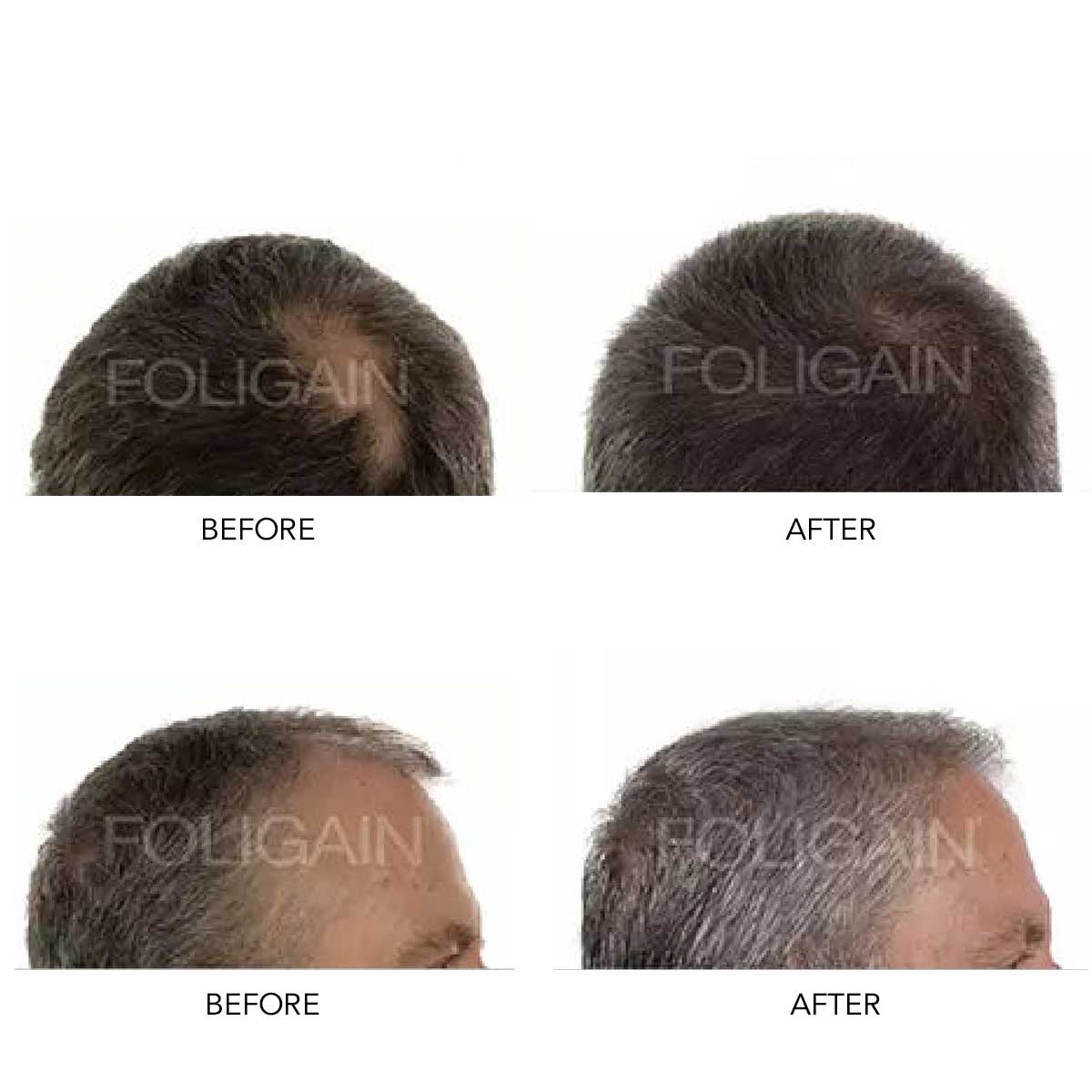 Discovering Effective Minoxidil Alternatives for Hair Growth – FOLIGAIN