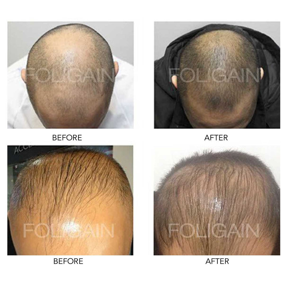 FOLIGAIN - Before and After Photos