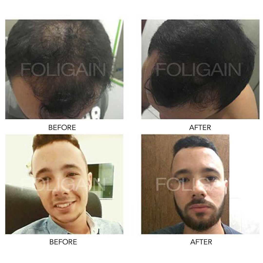 FOLIGAIN - Before and After Photos