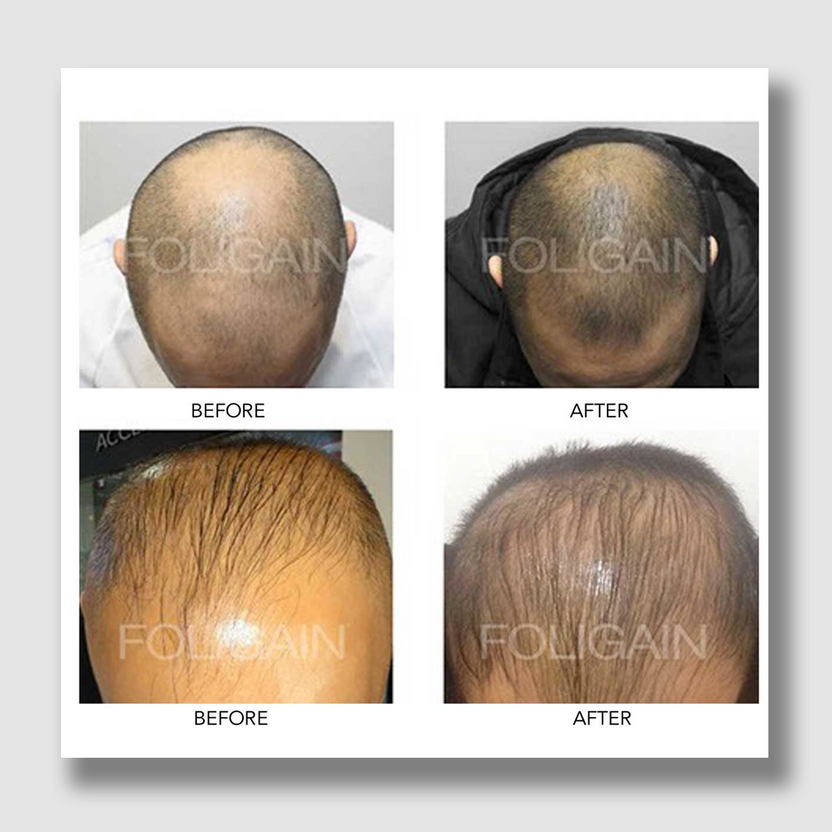 Mastering Minoxidil: Essential Dos and Don'ts for Optimal Results ...