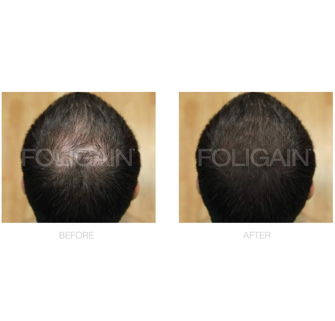 FOLIGAIN Low Alcohol Minoxidil 5% Hair Regrowth Treatment For Men